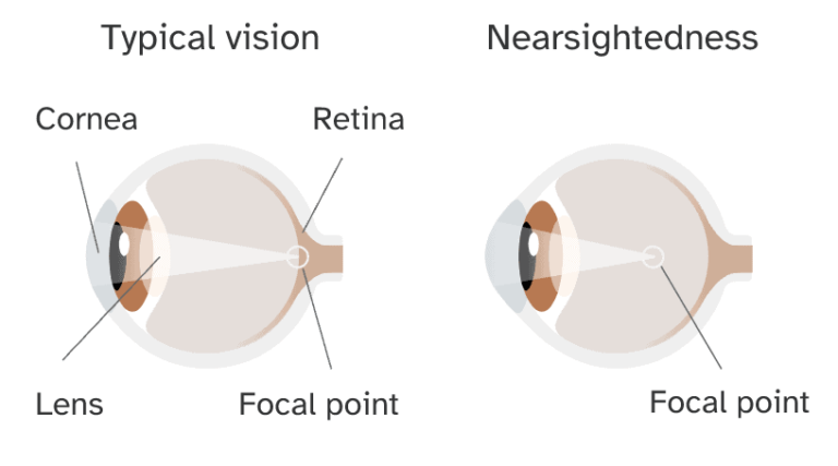 Nearsightedness: Genetics and More - 23andMe