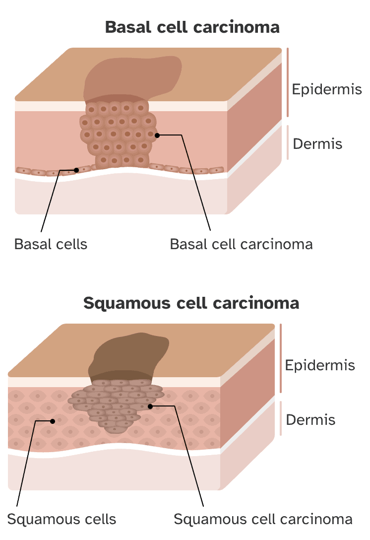 Are Basal and Squamous Cell Skin Cancers Genetic? - 23andMe
