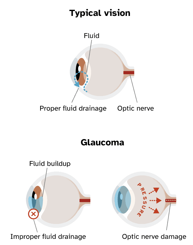 Is Glaucoma Genetic? Genetic Testing for Glaucoma - 23andMe