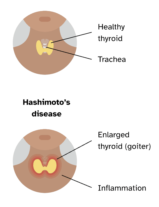 Is Hashimoto’s Disease Genetic? Genetic Testing for Hashimoto’s Disease ...
